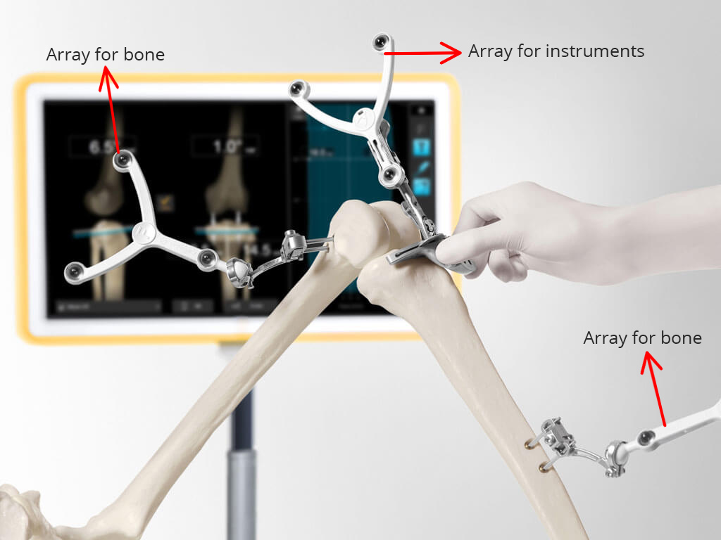 Computer Assisted Joint Replacement in Bangalore | Dr Basavaraj CM